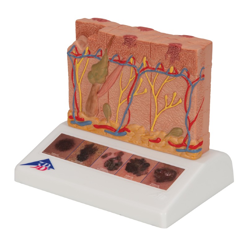 3B Scientific Magnified Skin Cancer Model | Health and Care